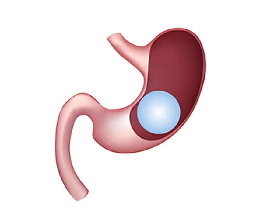 Intra Gastric Balloon | Best Laser Bariatric Surgery